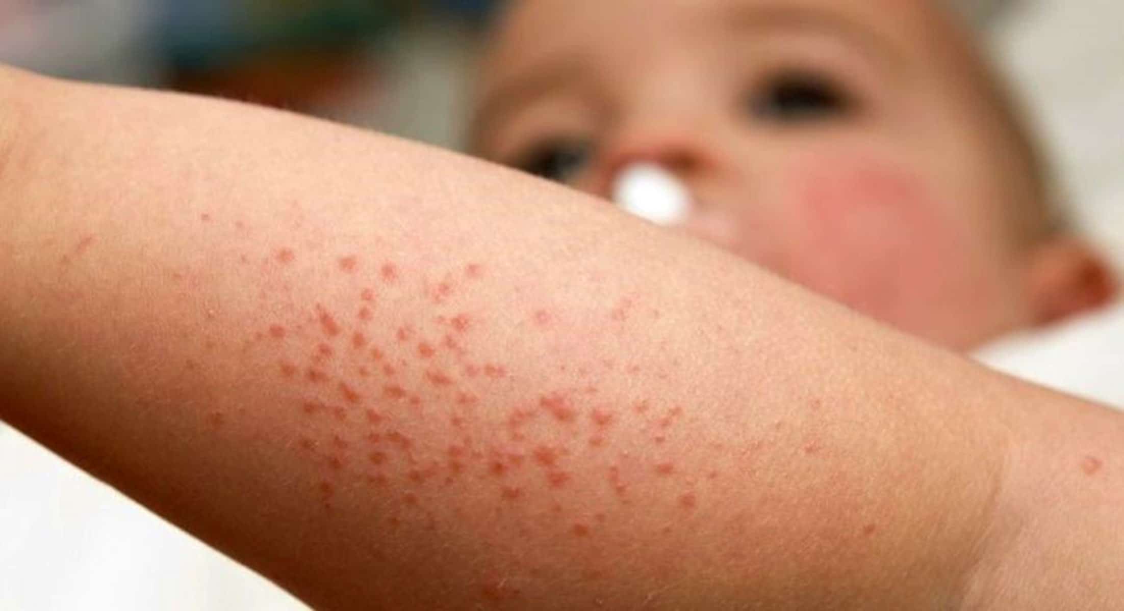 Descubren origen de la comezón crónica; patentarán expertas de la UNAM ...